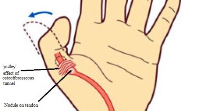 How to Stop Finger Twitching, Pinky Thumb, Index Middle