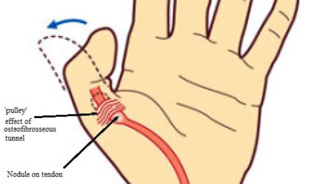How to Stop Finger Twitching, Pinky Thumb, Index Middle